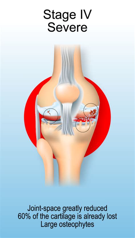 Bone On Bone Knee Pain Arthritis Knee Pain Center