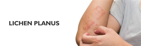 Lichen Planus Types Symptoms Causes And Treatment