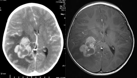 Choroid Plexus Carcinoma Radiology Cases