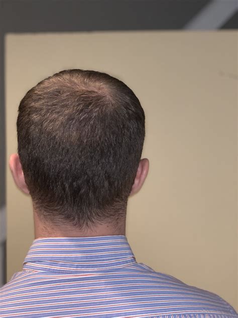 Finasteride Results 15 Years Page 2 Hair Transplant Reviews