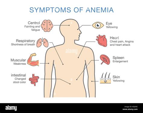 Anemia Symptoms