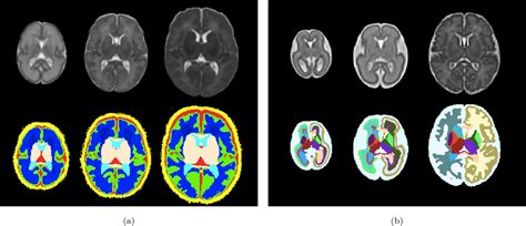 Figure 2 From An Automatic Pipeline For Atlas Based Fetal And Neonatal Brain Segmentation And