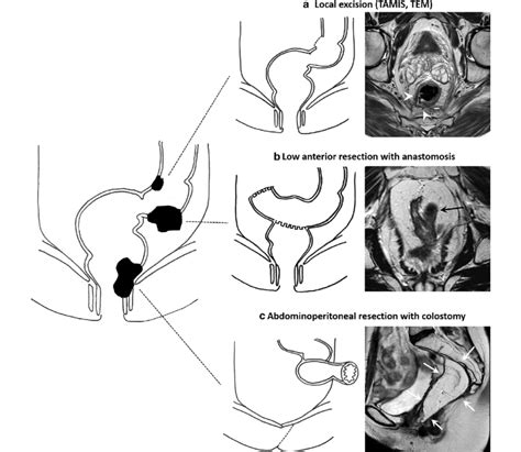 Schematic Illustration Showing Different Surgical Techniques Used To Download Scientific