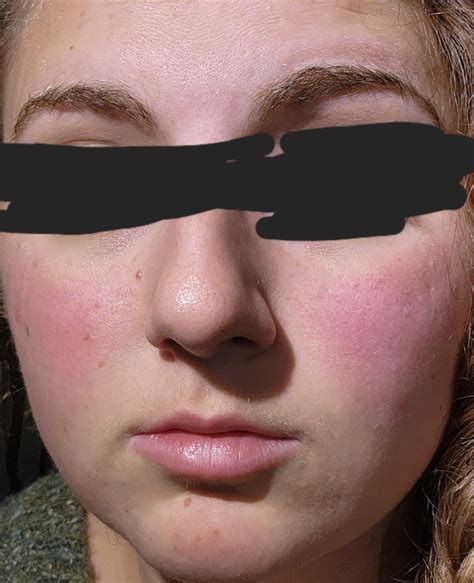 Does This Look Like A Malar Rash R Autoimmune