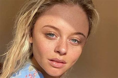 Emily Atack Shows Off Her Natural Freckles After One Day Of Sun As She