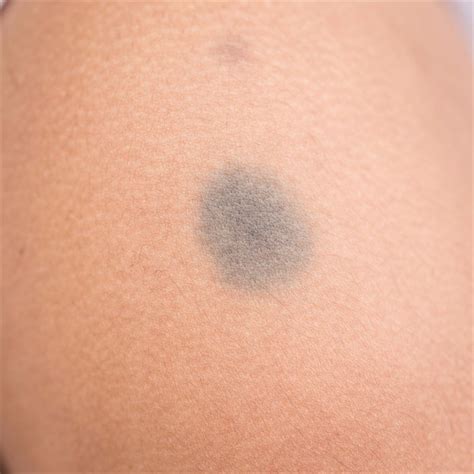 What Are Birthmarks Types And Treatments Upmc Healthb