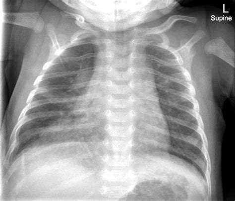 Infant Community Acquired Tuberculosis Cxr Ap Jetem 2023 Jetem