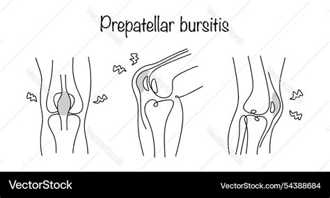 Prepatellar Bursitis Royalty Free Vector Image
