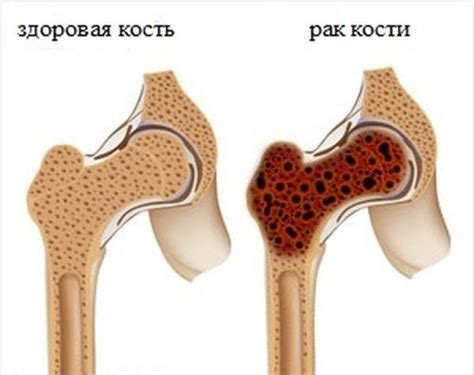 Рак костей признаки причины симптомы лечение и профилактика