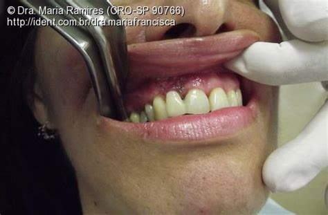 Cirurgia de Estética na Gengiva Inserida Defeito Causado por Perda Óssea Vestibular de