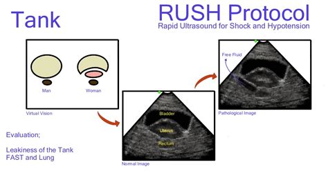 Rapid Ultrasound For Shock And Hypotension Rush Protocol Us Imaging