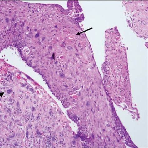 A 64 Year Old Patient With Palpable Left Breast Mass Diagnosed As