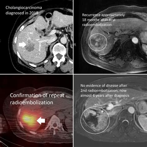 Cholangiocarcinoma Radiology