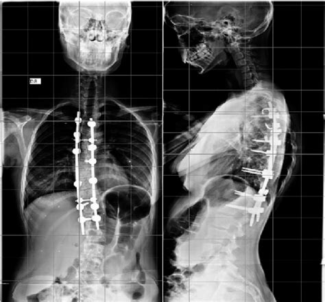 Figure 1 From Effect Of Body Mass Index Percentile On Clinical And