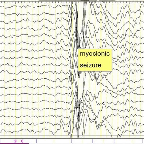 Ictal Eegs Demonstrating The 2 3 Hz Generalized High Amplitude