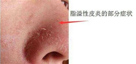 鼻翼兩側的紅血絲是怎麼回事？怎麼消除？ 每日頭條