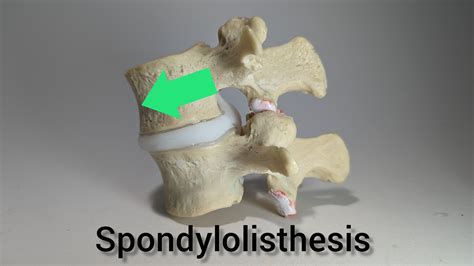 Spondylolisthesis L2 3 Grade 1 Understanding Anterolisthesis In Spine