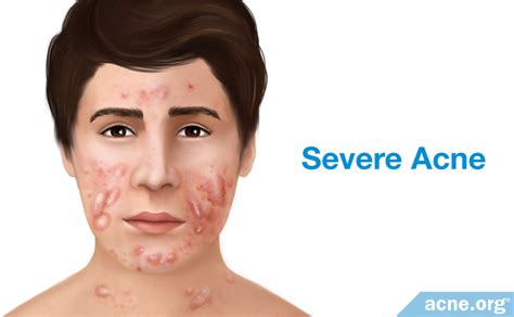 What Is Acne An In Depth Look