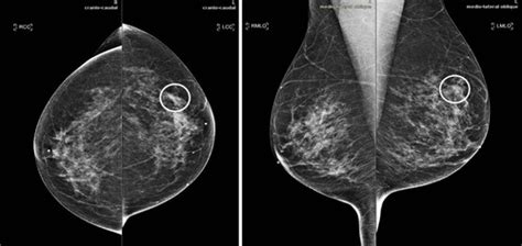 Breast Flashcards Quizlet