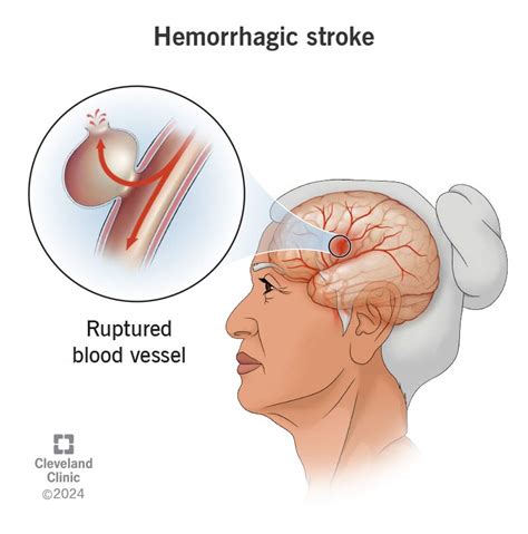 Intracerebral Hemorrhage Symptoms Intracerebral Hemorrhage