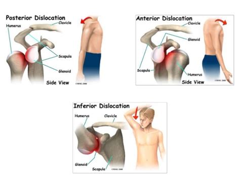 Shoulder Dislocation Causestypessymptoms And Treatment How To Relief