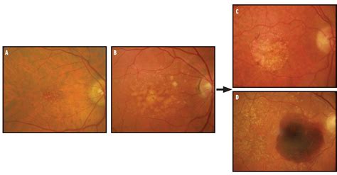 Rethinking Our Amd Nomenclature Retina Today