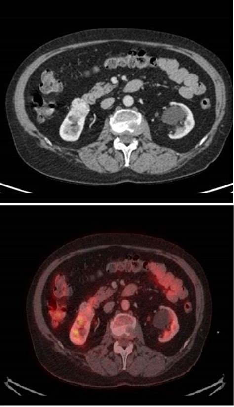 Case 14 Axial Ct And Petct A 65 Year Old Woman With Rectal Cancer
