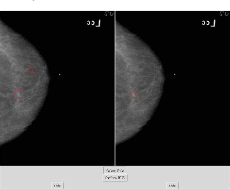 figure 3 from mammogram based cancer detection using deep convolutional