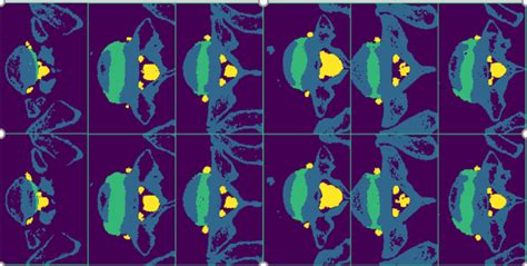 Unet3D Bagging CT Spine Segmentation Data 3Dp Py At Master Huatsing