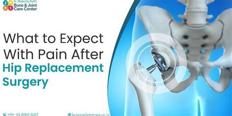 Sharp Pain After Hip Replacement Surgery At Fred Morales Blog