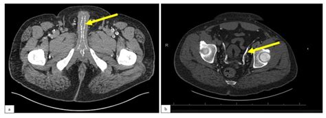 A Non Contrast Ct Scan Showing Extensive Calcification Of The Download Scientific Diagram