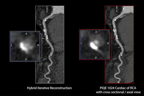 PIQE AI Deep Learning Reconstruction Computed Tomography CT
