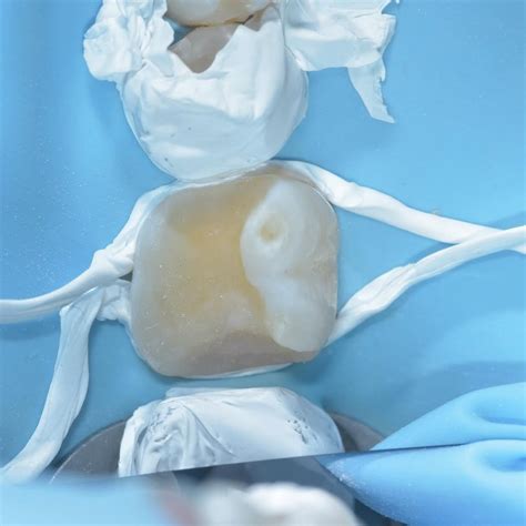 Deep Margin Elevation And Biologic Width — Alleman Center Of Biomimetic Dentistry