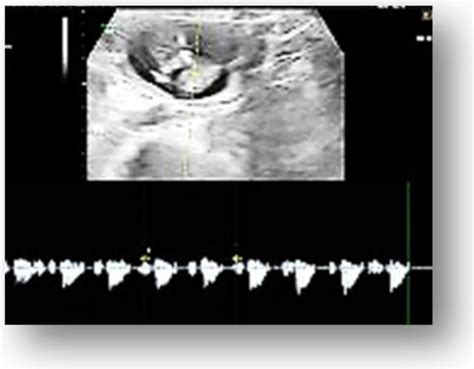 Medicina Free Full Text The Very First Romanian Unruptured 13 Weeks