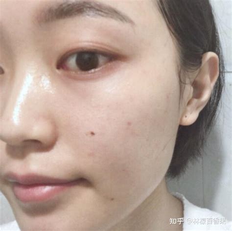从医学角度来说为什么脸上痘痘总是反反复复消不干净 知乎