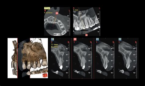 3d Cbct Компютърна Томография