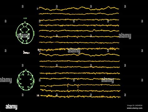 Focal Epilepsy Electroencephalogram Eeg Showing Focal Epileptic Spikes Over The Left Mid