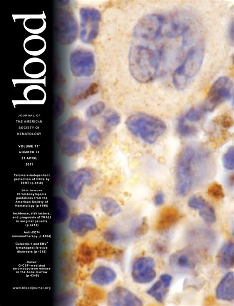 Pseudothrombocytopenia Blood American Society Of Hematology