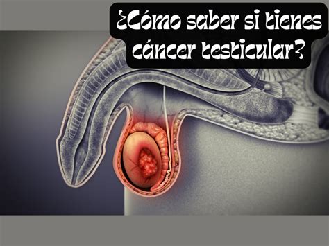 Cómo saber si tengo cáncer testicular