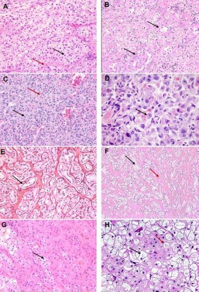 Unclassified Renal Cell Carcinoma Diagnostic Difficulties And Treatme