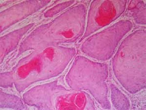 Ulceration With Invasion Of Malignant Keratinizing Squamous Cells