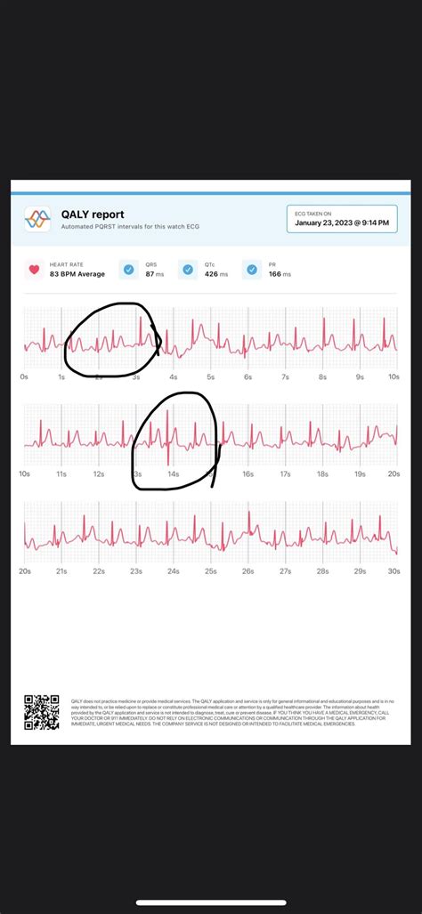 Anyone Else Get Ectopics When They Lay Down But When They Sit Up They Pretty Much Go Completely