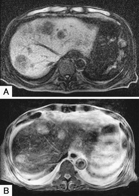 Figure 2 From A Case Of Hepatic Angiosarcoma That Was Diagnosable With
