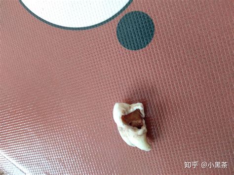 清理牙结石是什么样的感觉 知乎