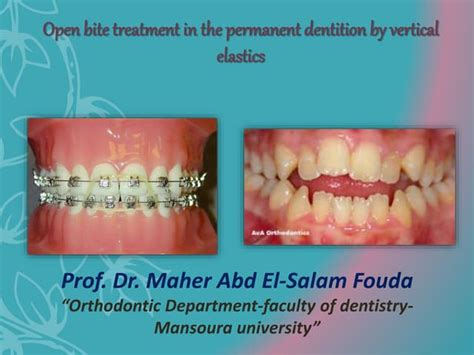 Elastics For Open Bite Treatment Pptx
