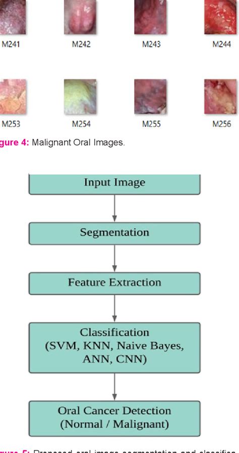 Figure From Oral Cancer Detection Using Machine Learning And Deep