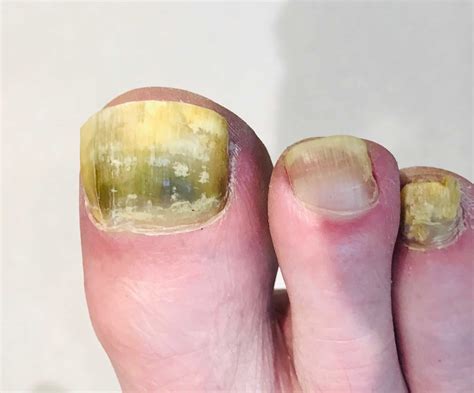 Fungal Nail Infections Causes Prevention And Treatmen