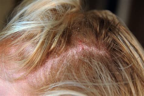 How To Prevent Treat Scabs On The Scalp After Bleaching Hair