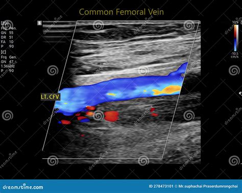 Color Doppler Ultrasound Determination In Deep Vein Thrombosis Patients