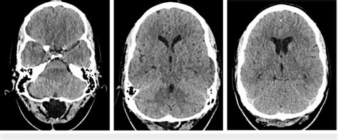 Ct Head After Posterior Fossa Re Exploration Surgery Download